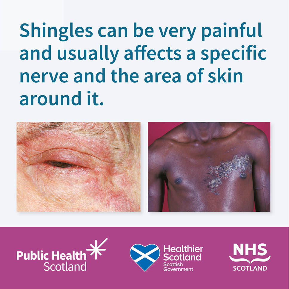 Shingles Vaccine (Static 1B) - September 2025 | Public Health Scotland News